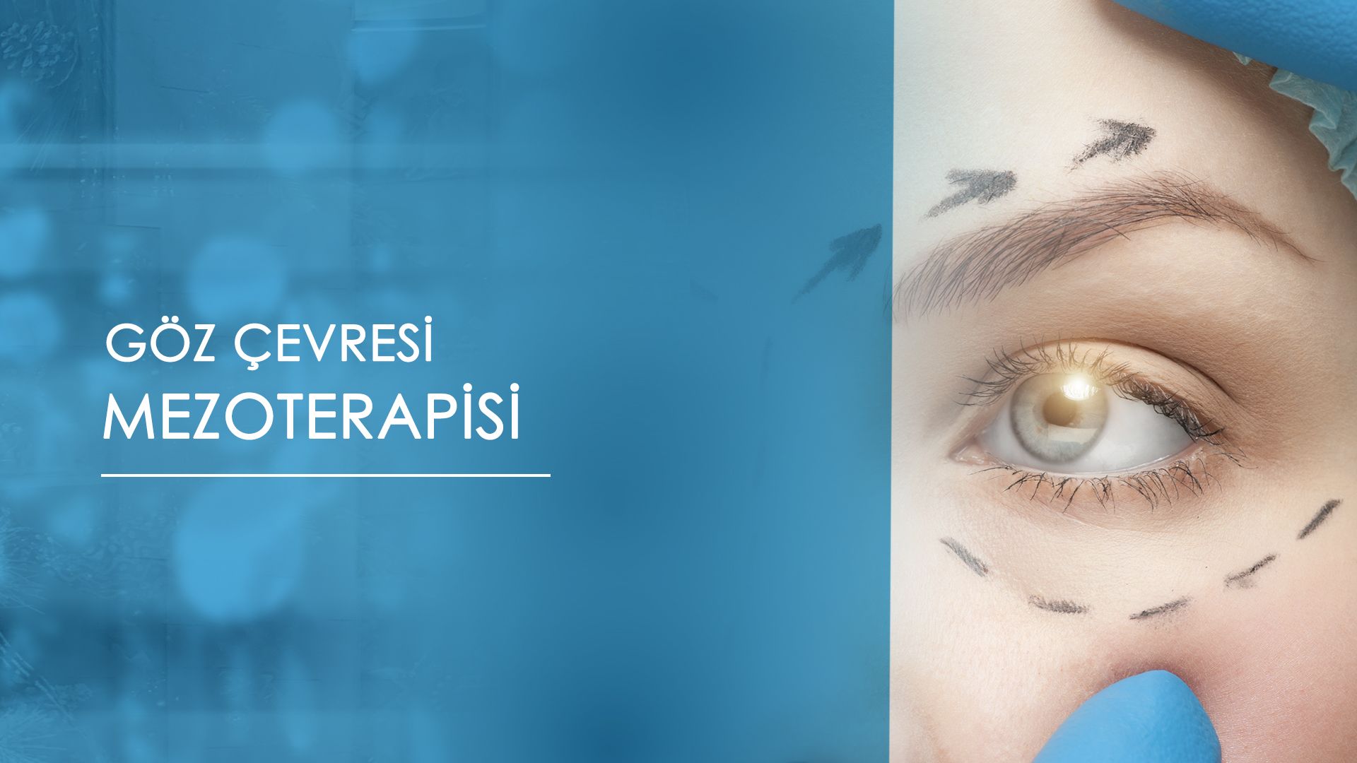 Eye Contour Mesotherapy - Veni Vidi Eye
